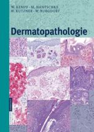 Epidermis Spongiose, Akanthose und Hyperparakeratose | SpringerLink