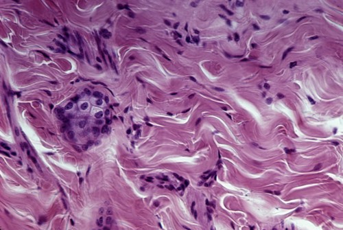 Fibrosis: Tissue Repair and Remodelling