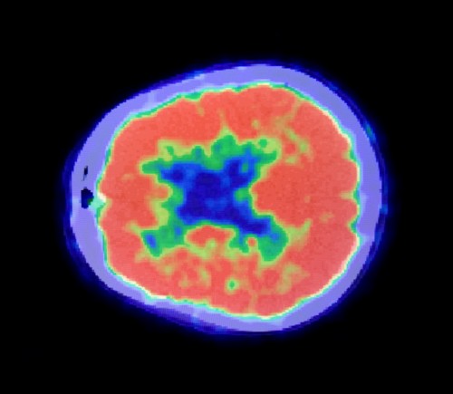 Radioisotopes and radiochemistry in health science