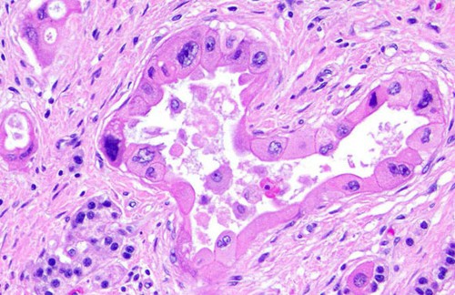 Pancreatobiliary Neoplasms