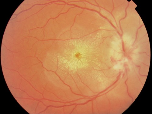Update in Neuro-Ophthalmology