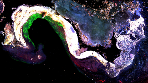 Ovarian Cancer Awareness Month