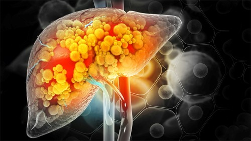 Advances in MASLD/NAFLD