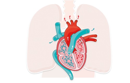 Single-ventricle heart defects