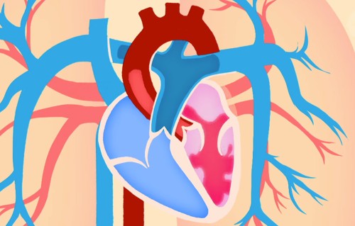 Single-ventricle heart defects
