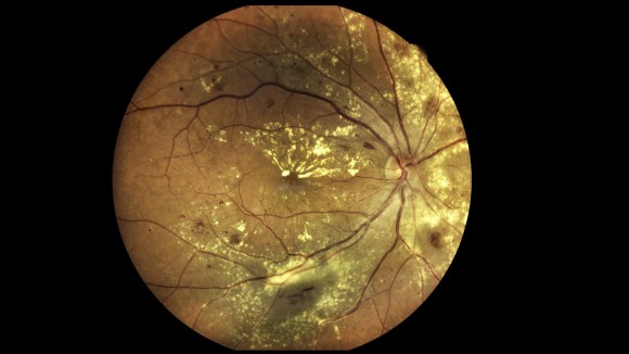 Macular degeneration