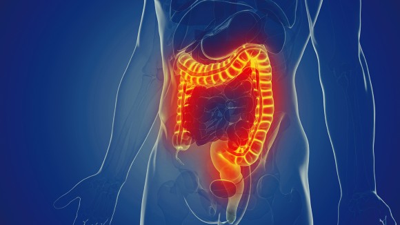 Crohn's and Colitis