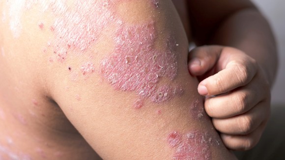 Psoriasis On Arms