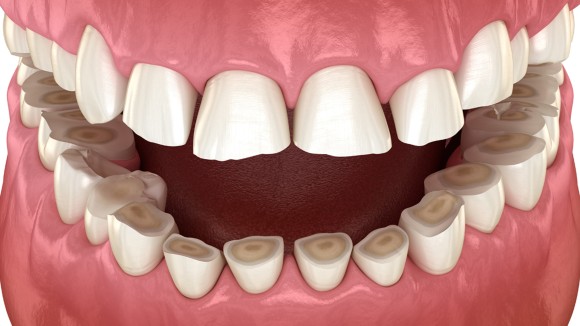 Tooth Wear