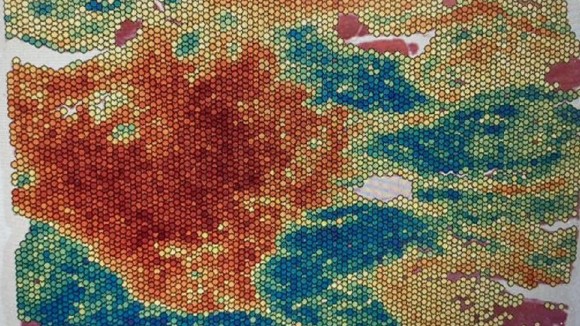 Spatial biology in cancer