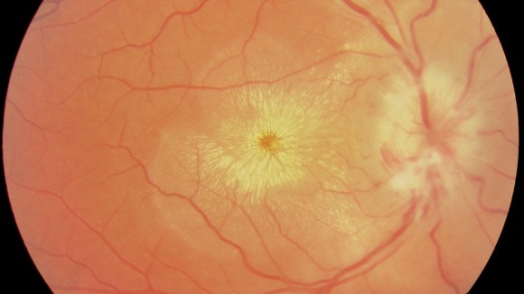 Update in Neuro-Ophthalmology
