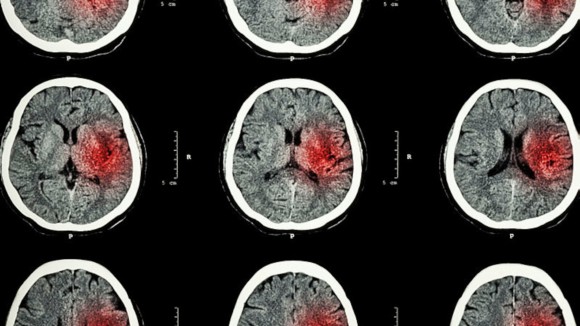 Post-stroke rehabilitation