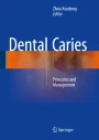 Dental Caries: Principles and Management | SpringerLink