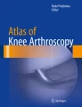 The hypermobile lateral meniscus: a retrospective review of ...