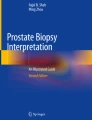 Evolution of Gleason Score Prostate — A Review | Indian Journal of ...