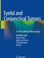 Conjunctival Nevus | Current Ophthalmology Reports