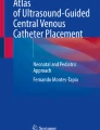 The Supraclavicular Approach to the Subclavian Vein | Springer Nature Link