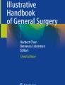 Open Retro-rectus Repair of Hernia | SpringerLink