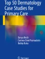 Leser-Trélat Sign, Eruptive Seborrheic Keratoses | Springer Nature Link ...