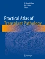 Simultaneous Pancreas and Kidney Transplantation | SpringerLink