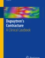 Congenital Curly Toe Contractures | Springer Nature Link