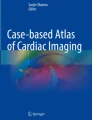 Complications Associated with Total Anomalous Pulmonary Venous ...